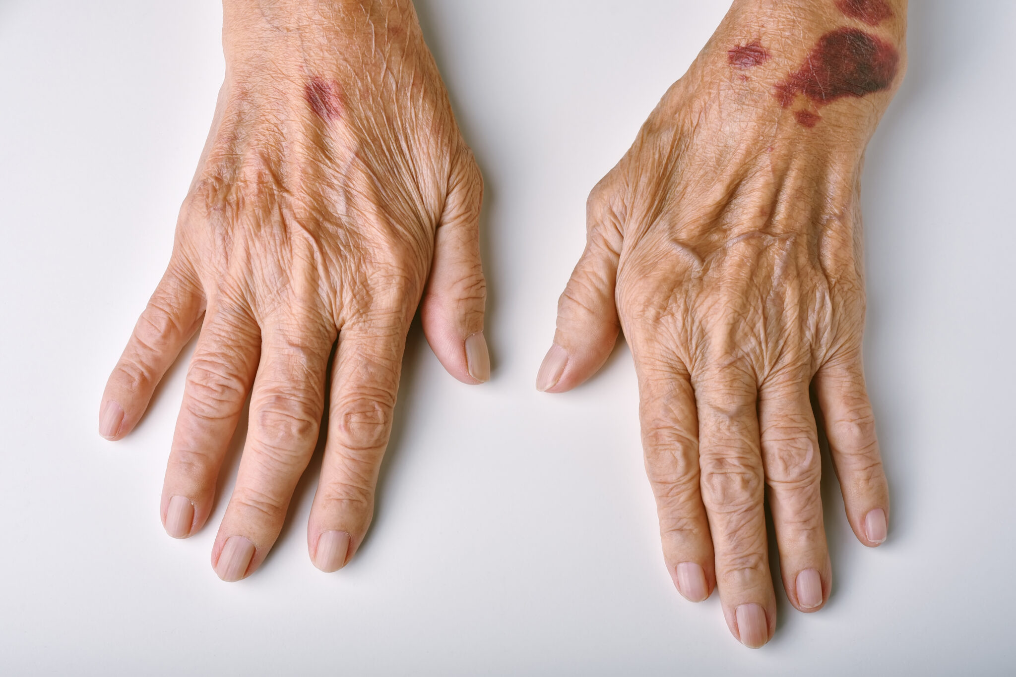 What is senile purpura? Causes and treatments